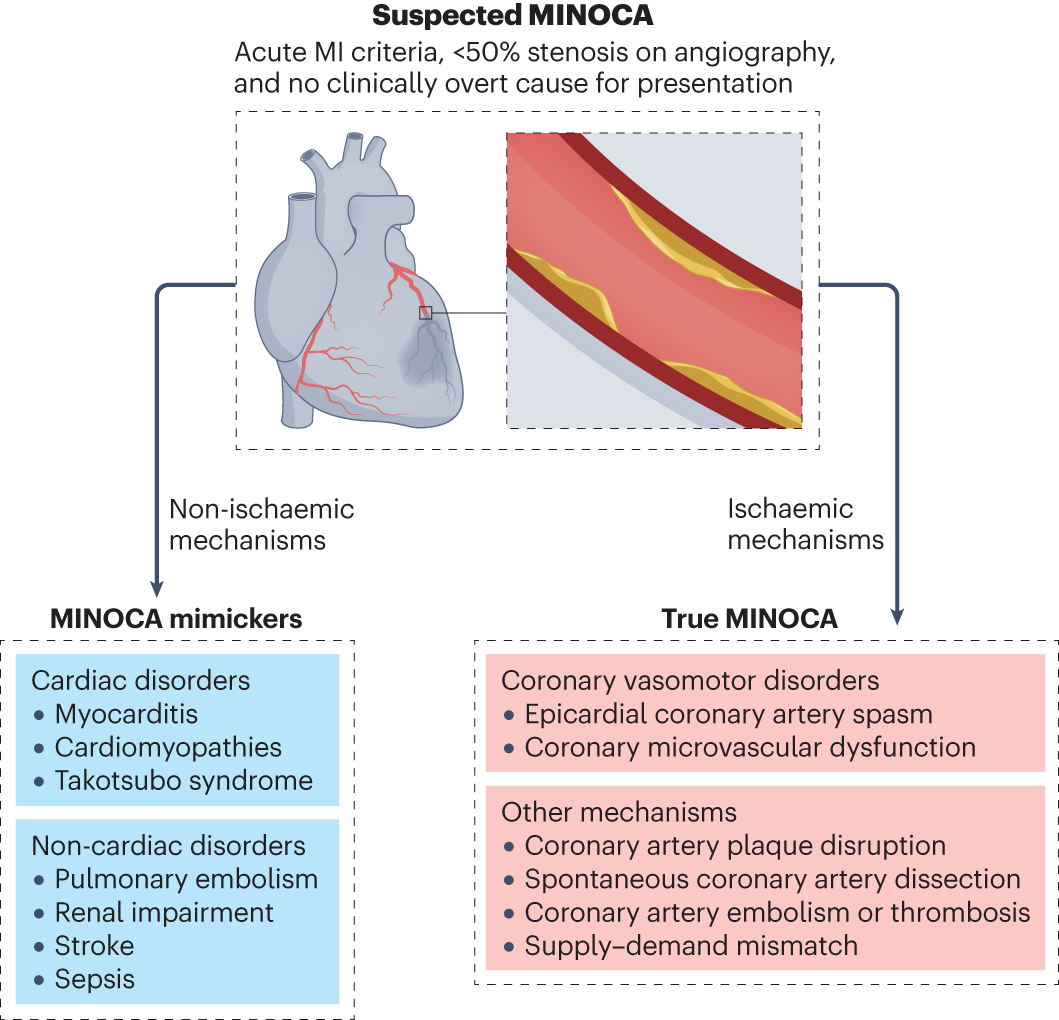 MINOCA | IAM Sin Lesiones Coronarias Obstructivas
