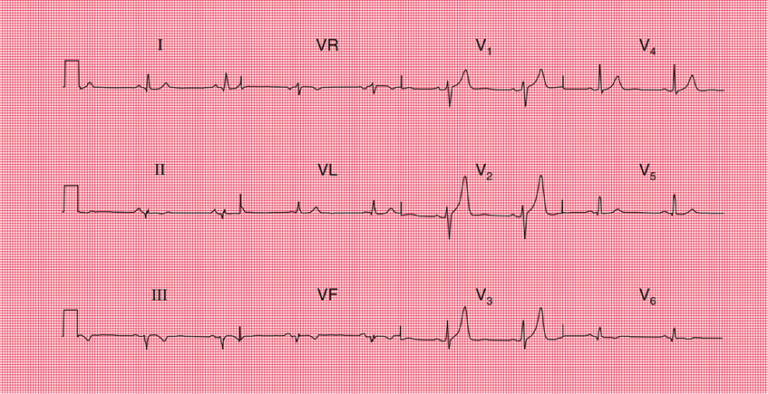 Infarto de Miocardio Inferior Antiguo | CASO CLÍNICO