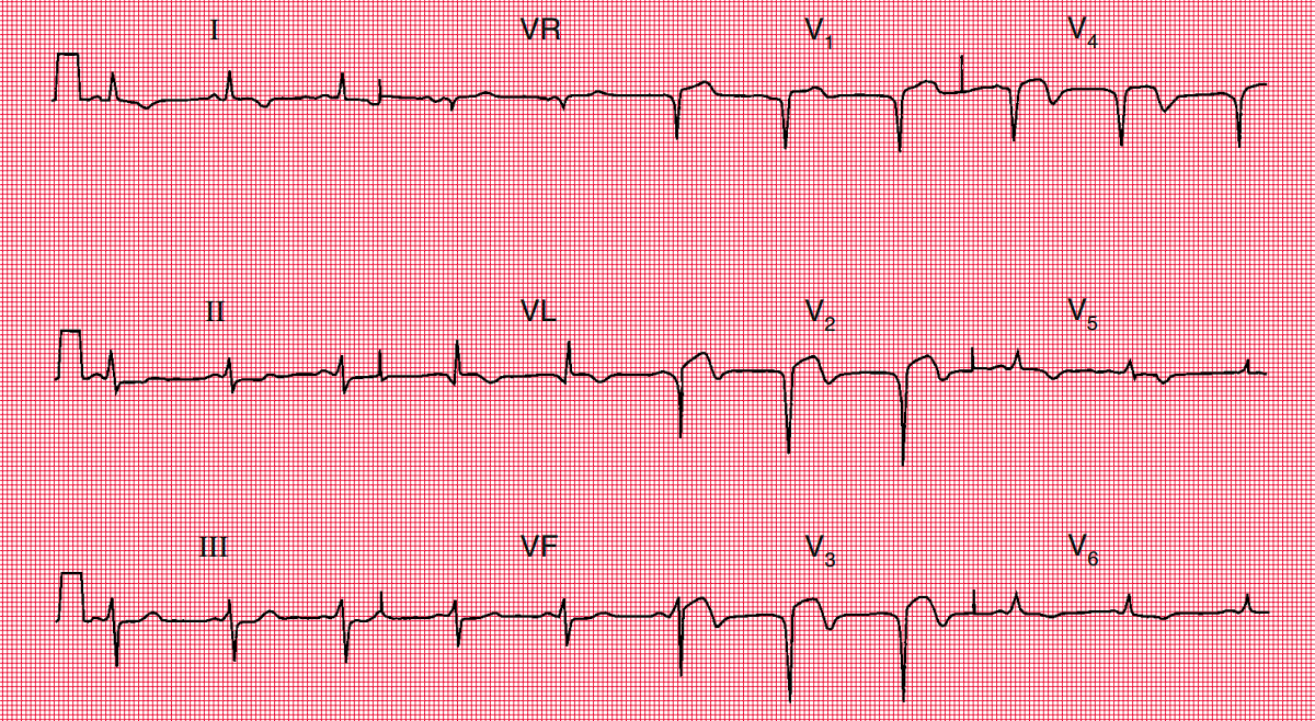 Infarto Agudo de Miocardio de Cara Anterior | CASO CLÍNICO