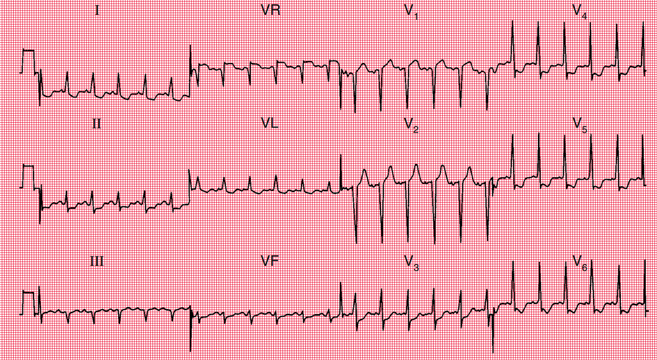 Angina Inestable | CASO CLÍNICO