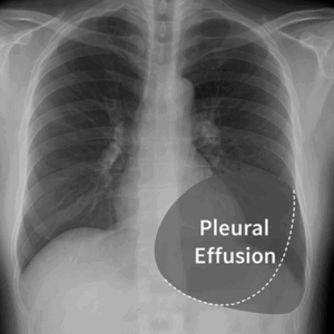 Derrame pleural: diagnóstico, estudios de extensión y abordaje clínico